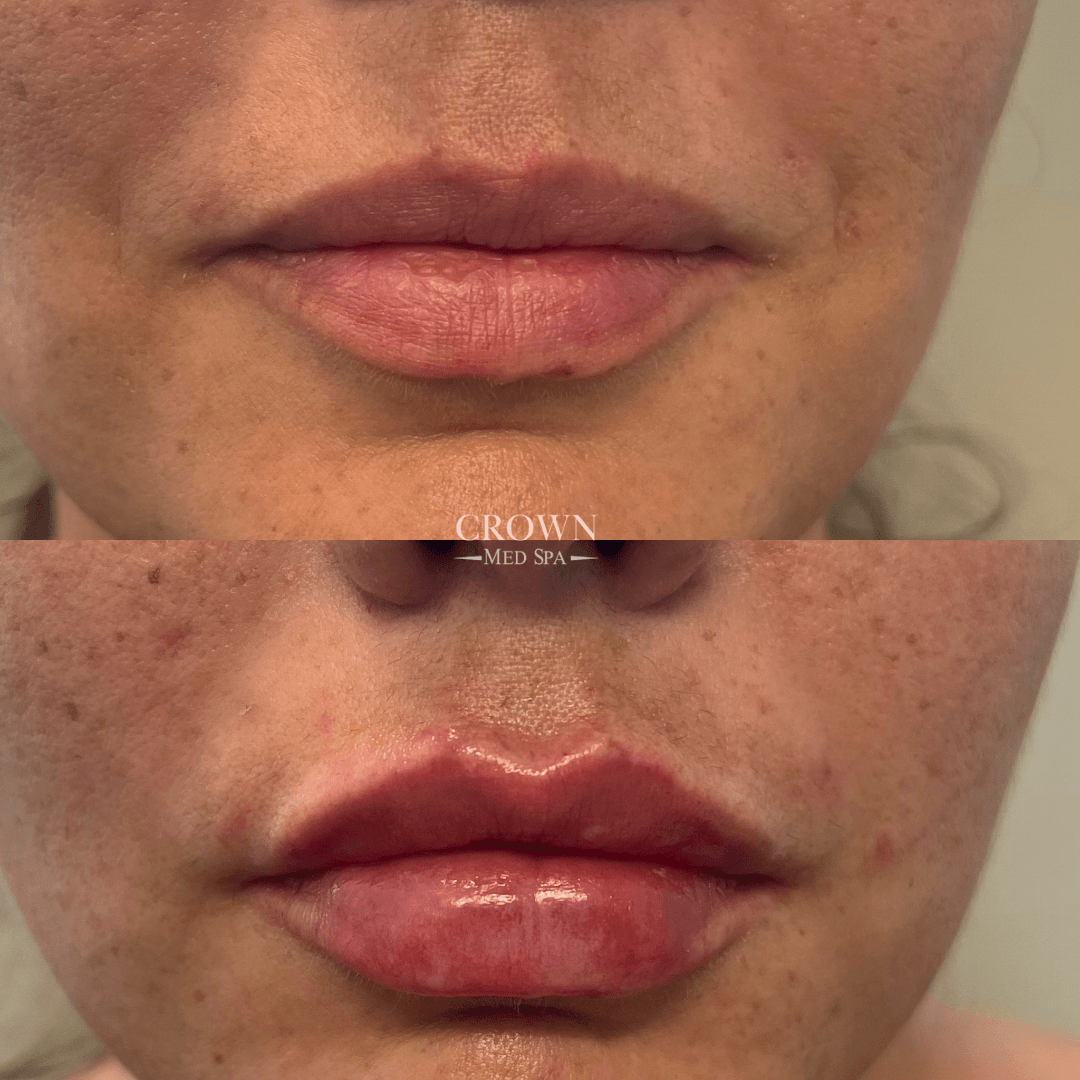 Dermal Fillers Crown Point | Crown Med Spa