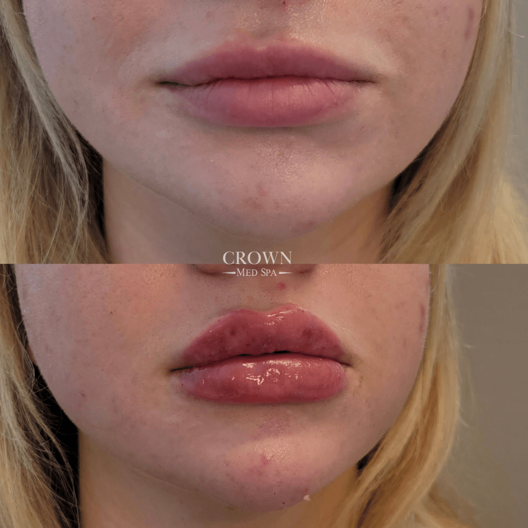 Dermal Fillers Crown Point | Crown Med Spa