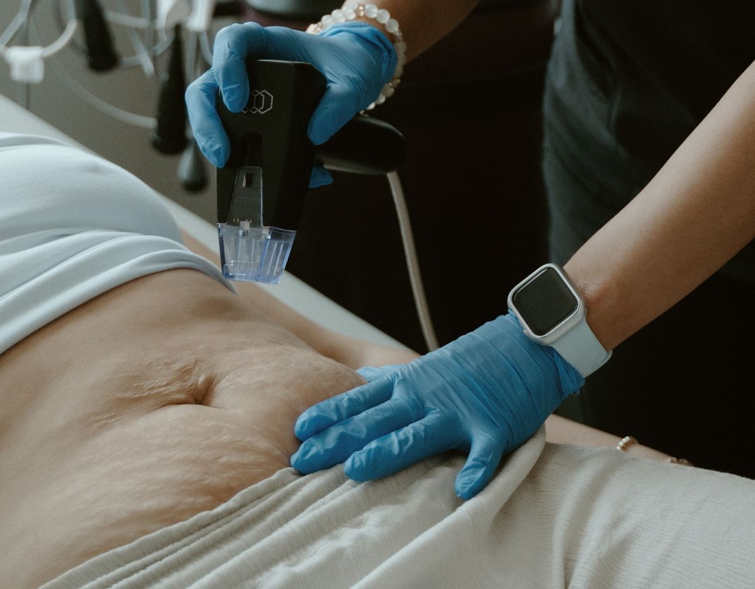 Stretch Mark Treatment Crown Point | Crown Med Spa