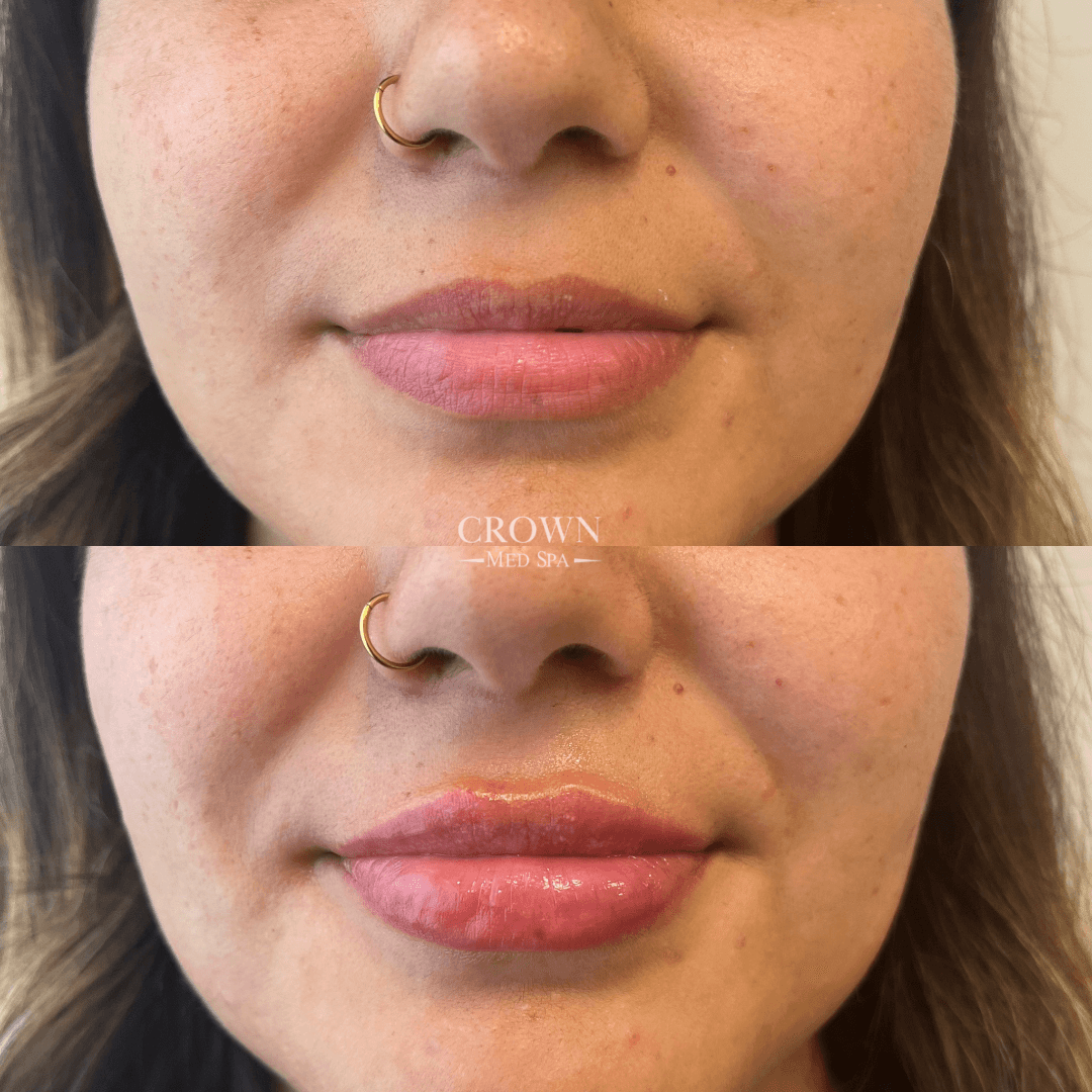 Dermal Fillers Crown Point | Crown Med Spa