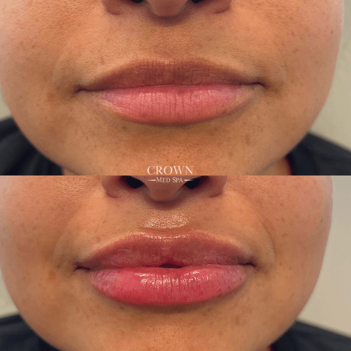Dermal Fillers Crown Point | Crown Med Spa