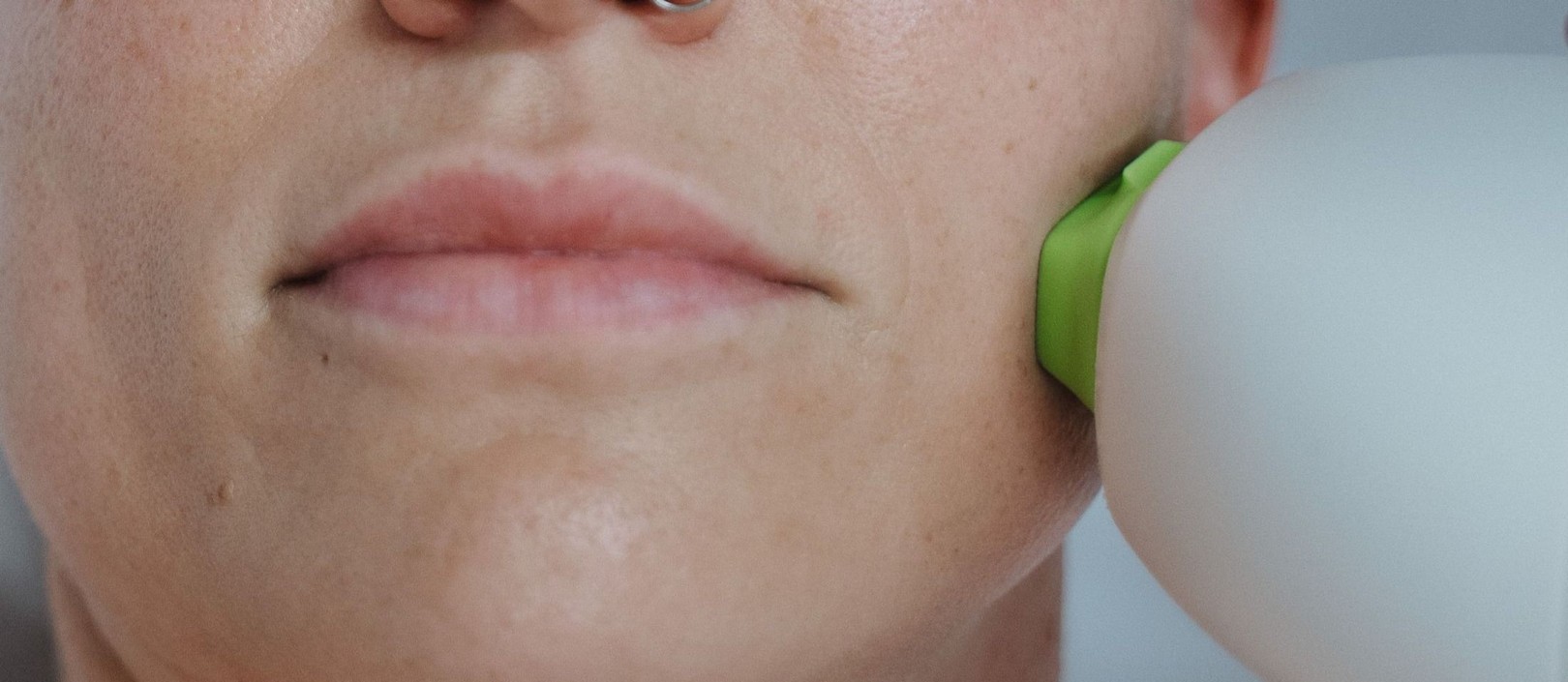 Rosacea Treatment Crown Point | Crown Med Spa